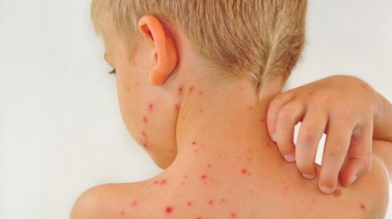 what causes mild shingles