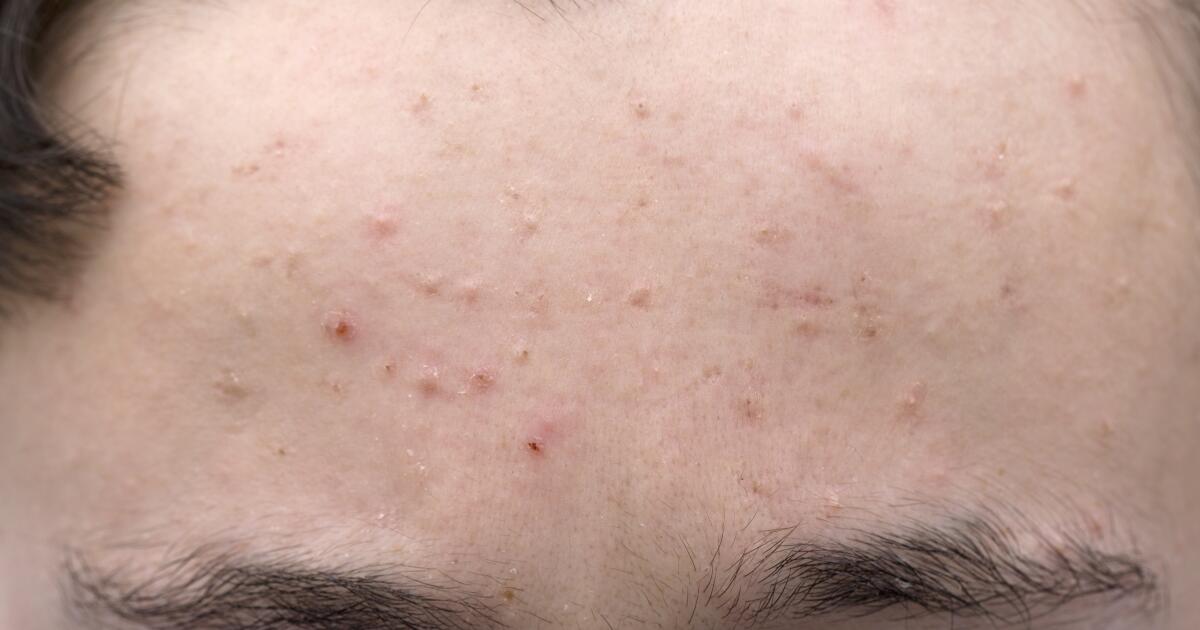 Comedonal Acne: Treatment, Causes & Symptoms