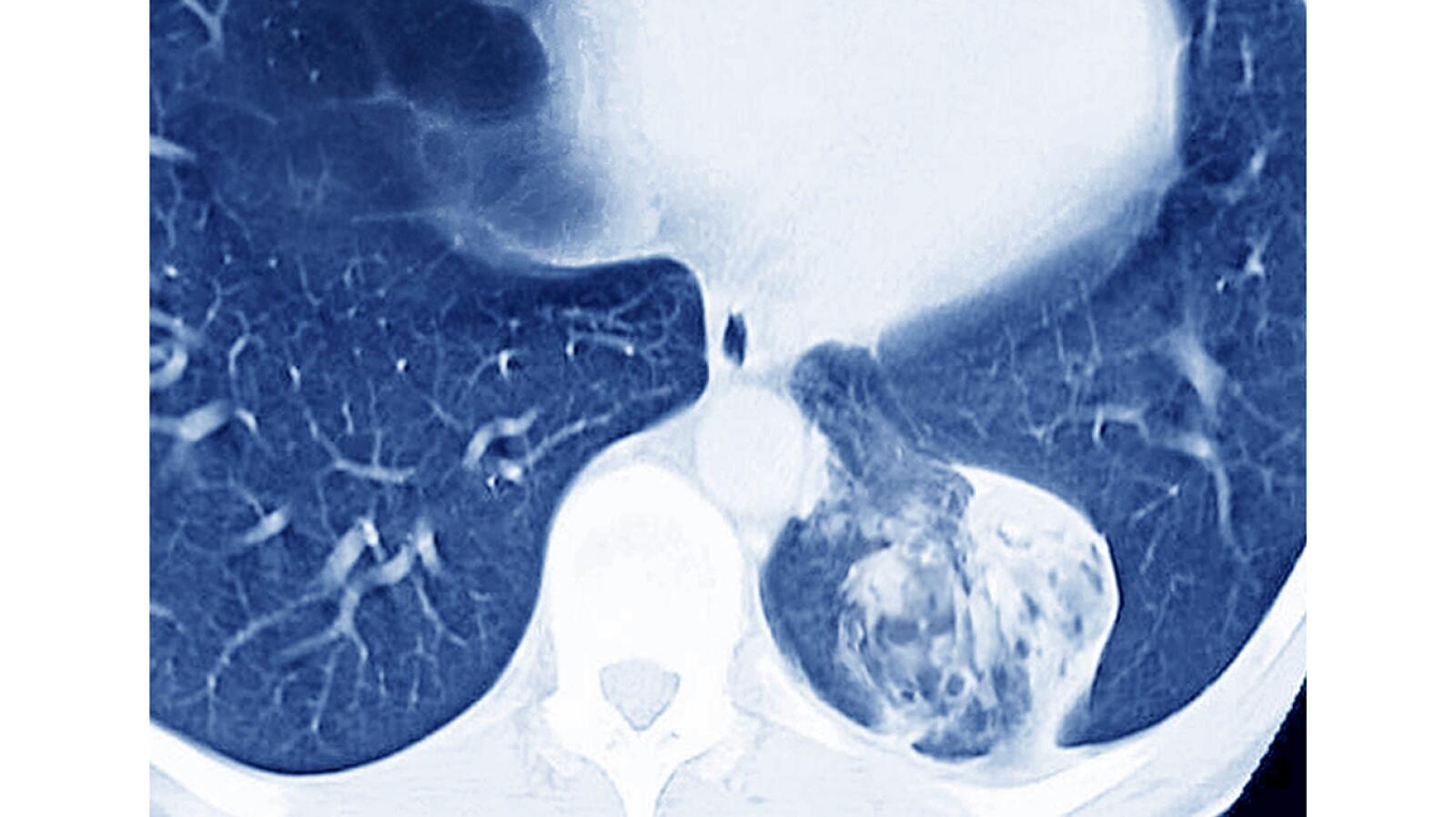 Real Lung Cancer Pictures, X-Rays, and Types