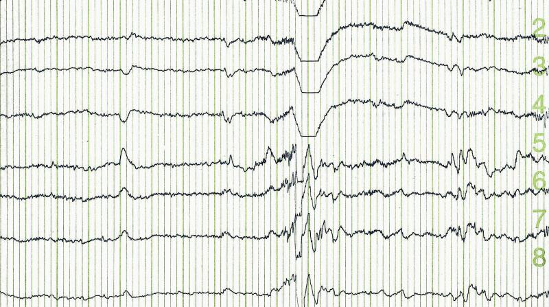 What to Know About EEGs | Electroencephalography for Neurological Symptoms