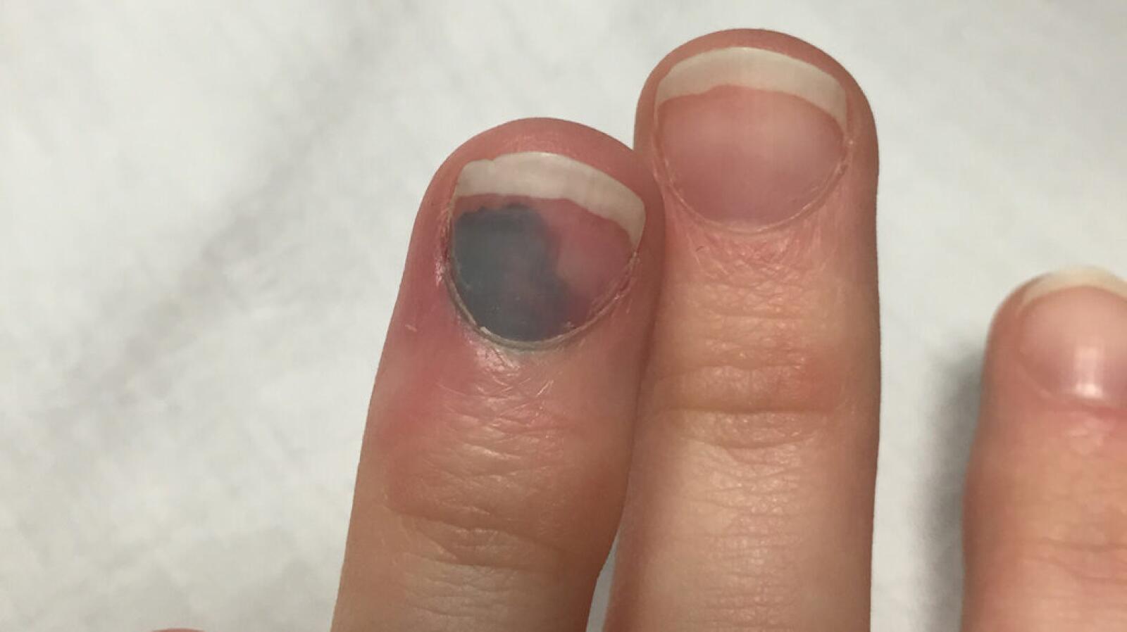 Subungual Hematoma: Causes and Treatment for Bleeding Under the Nail