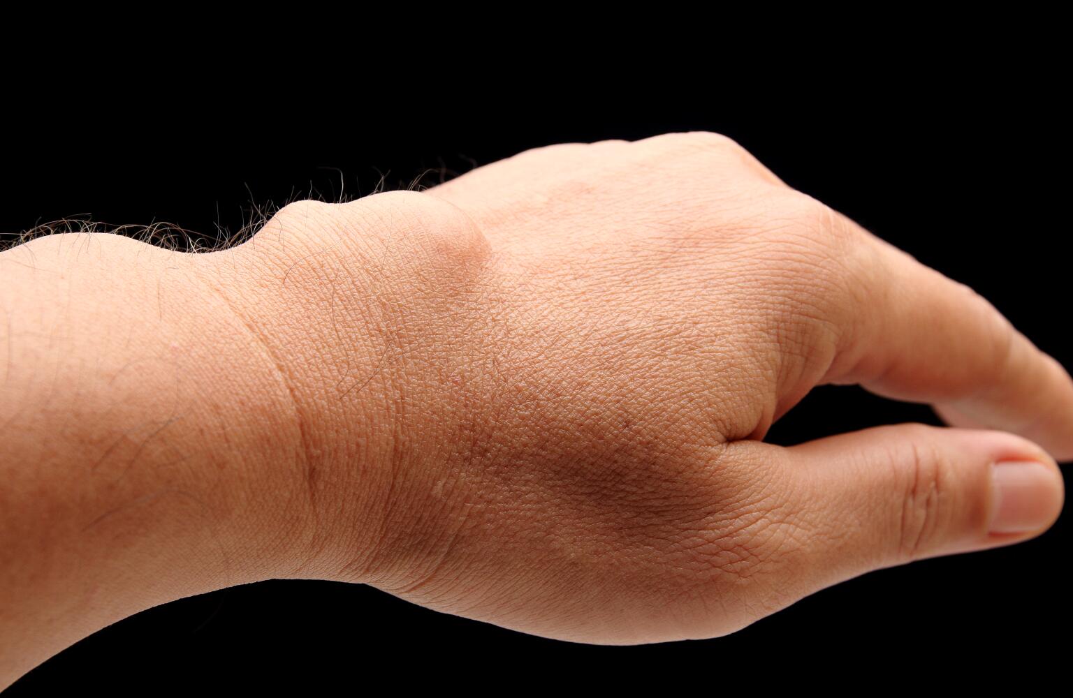 Ganglion Cyst: Frequently Asked Questions