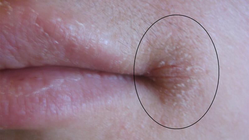 minor angular cheilitis