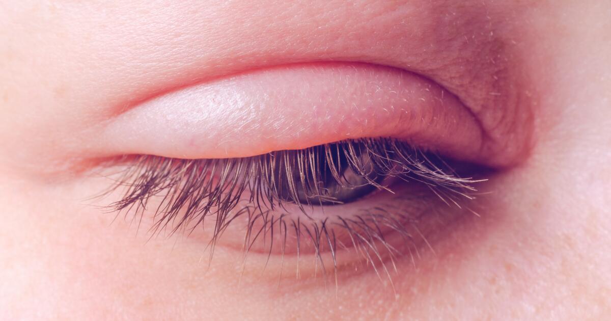 blepharitis face wash