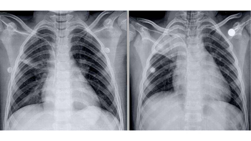 Atelectasis: Causes, Symptoms, Diagnosis, and Treatment