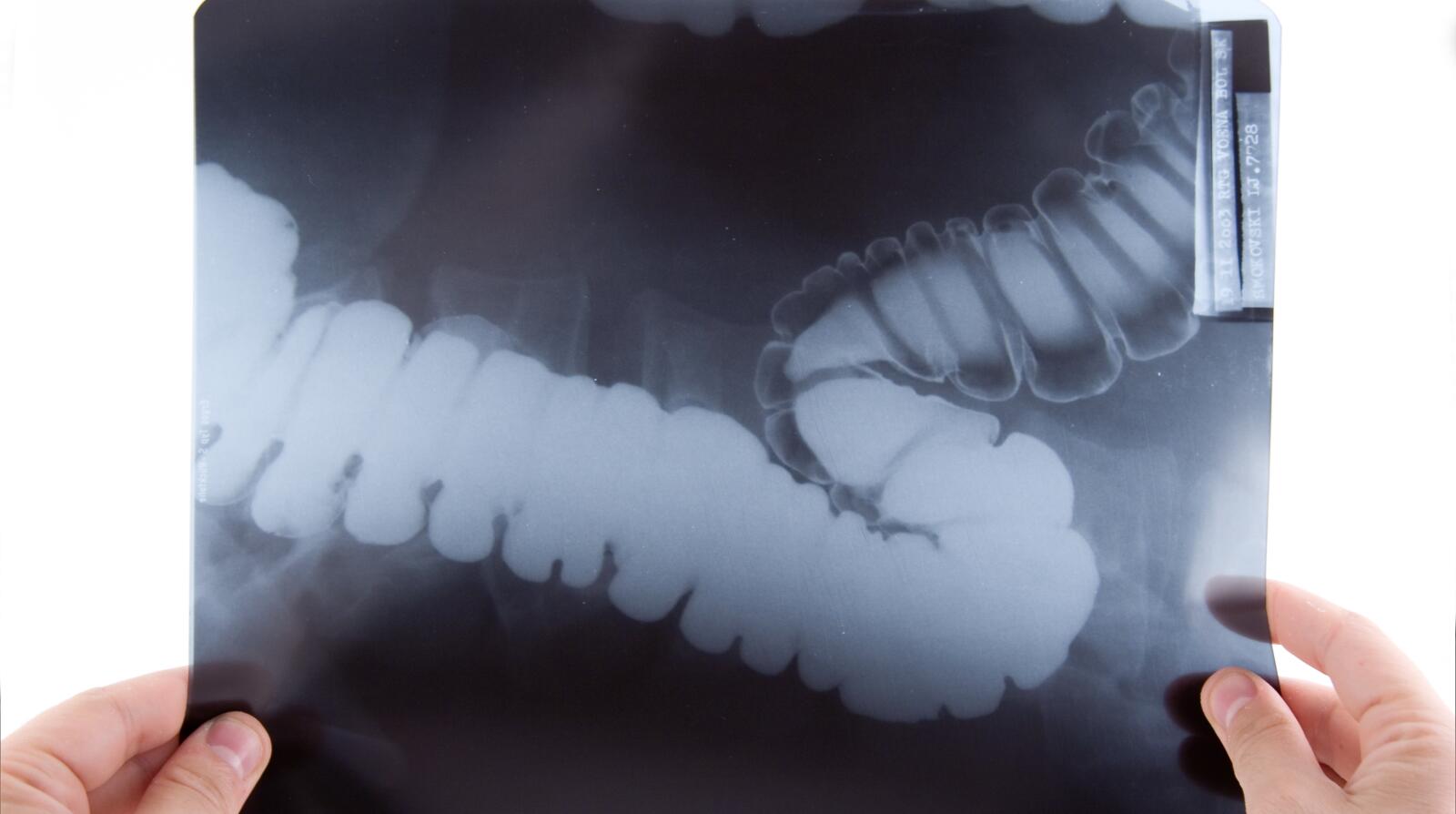 Top 6 Reasons for a Colostomy