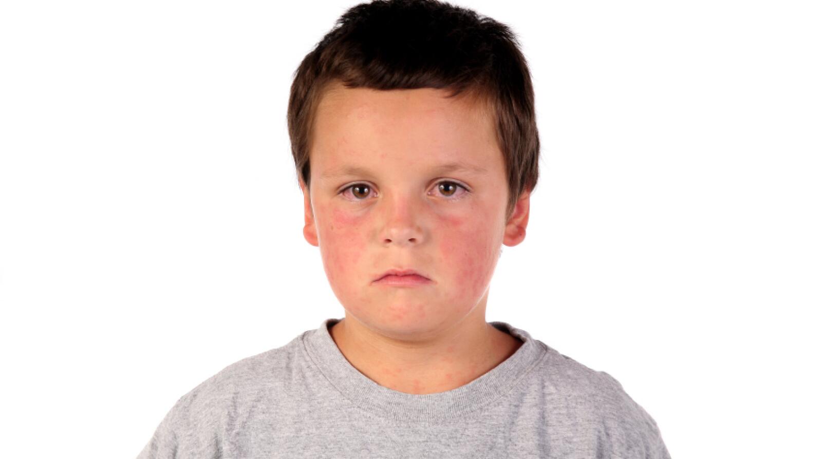 7 Common Contagious Diseases in Childhood