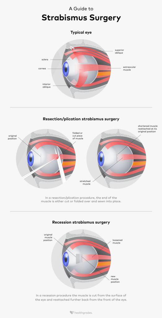 Strabismus Surgery Procedure Effectiveness And Risks
