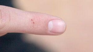 When to Worry About a Spider Bite and What to Do