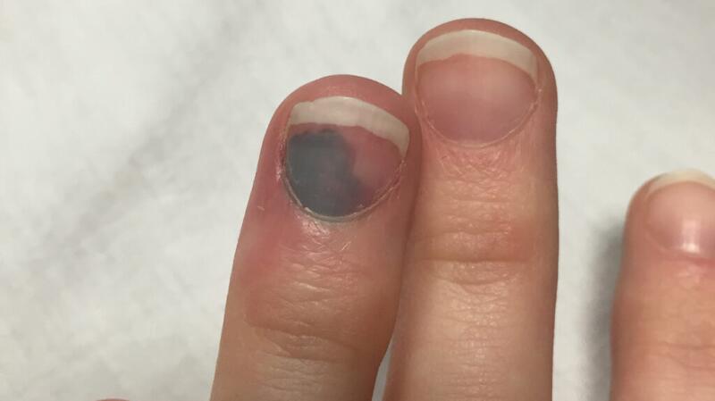 Subungual Hematoma: Causes and Treatment for Bleeding Under the Nail