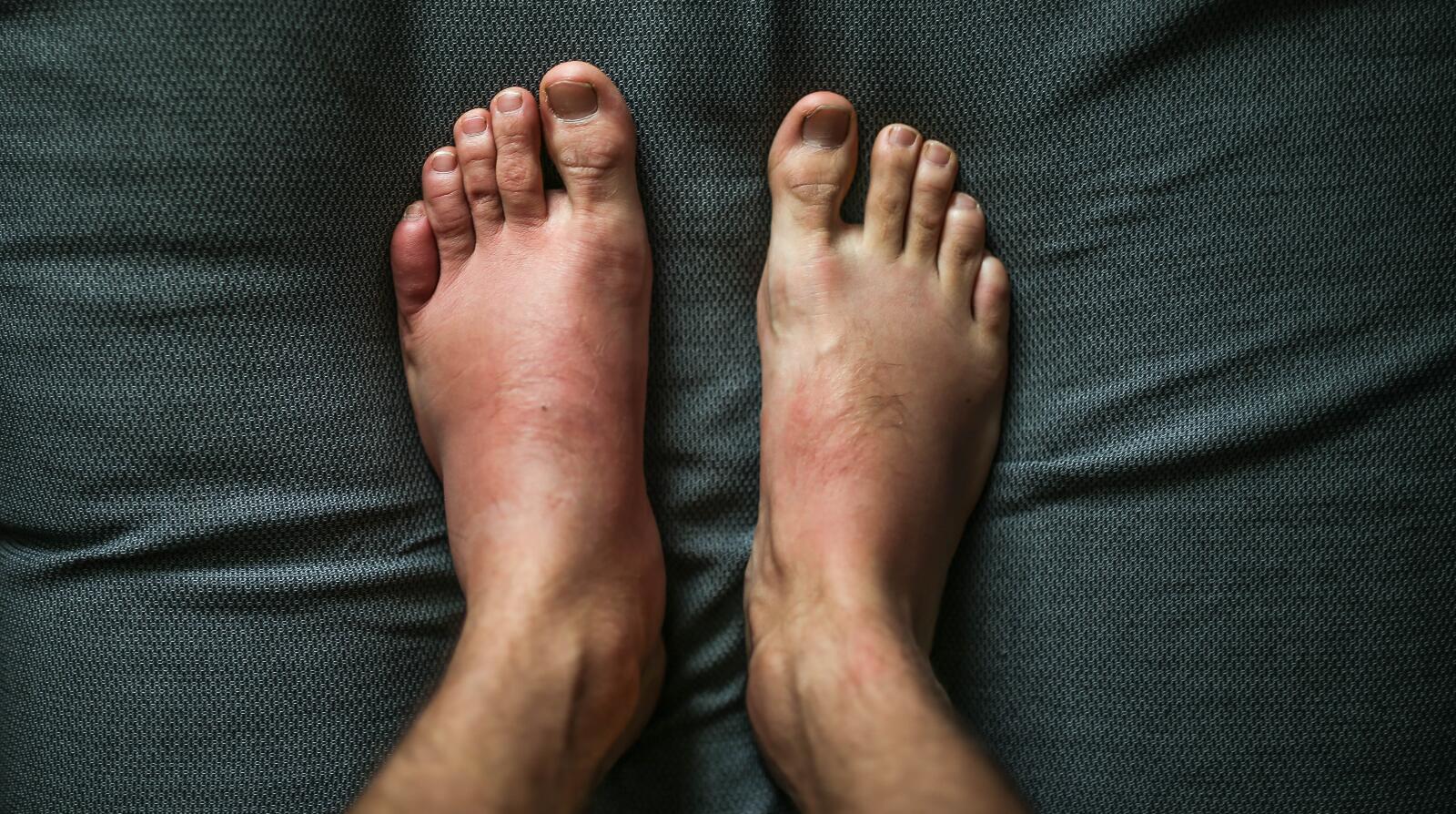 8 Surprising Cellulitis Facts | Is Cellulitis Contagious?