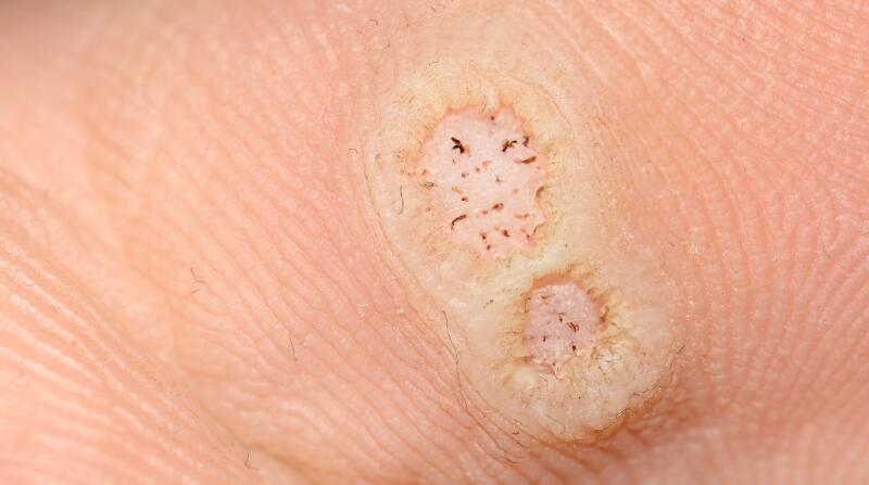 6 Things to Know About Plantar Warts