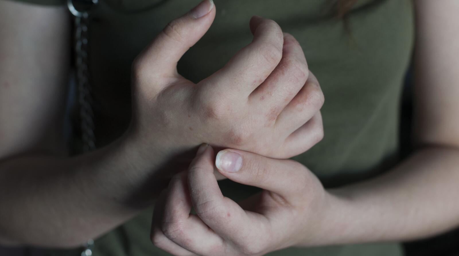 10 Things to Know About Scabies | Skin Mites