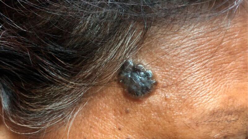 Images of Basal Cell Carcinoma: Pictures by Stage and Type