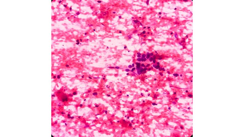 Real Lung Cancer Pictures, X-Rays, and Types