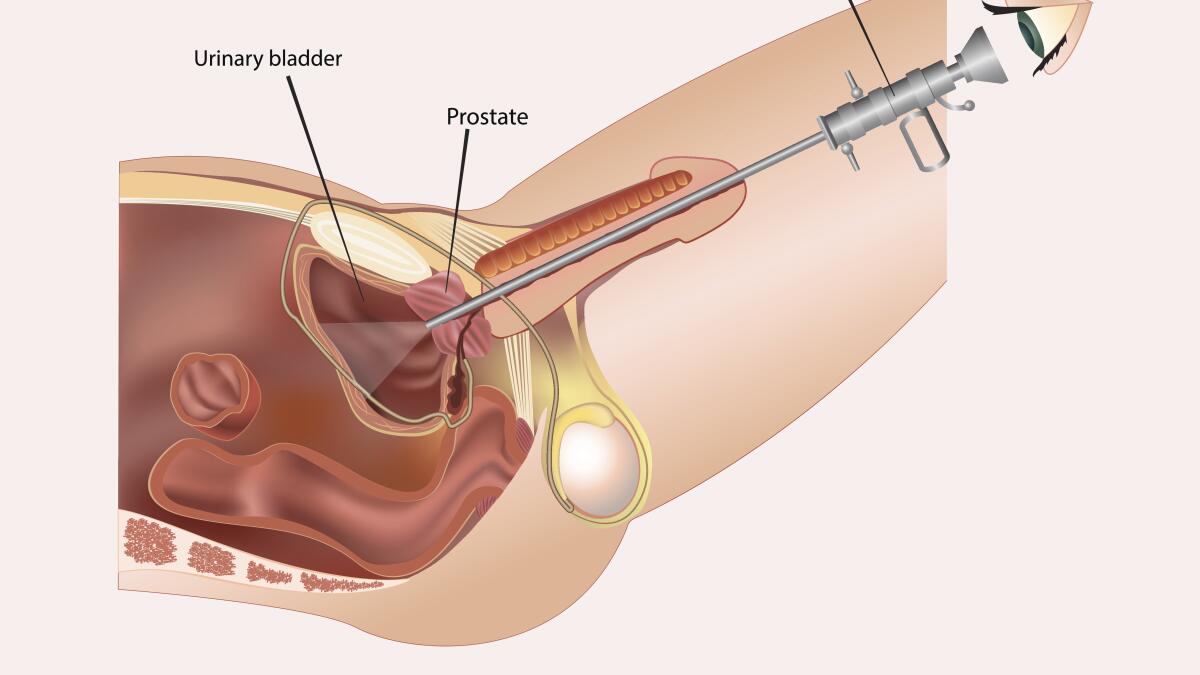 rigid cystoscopy uk