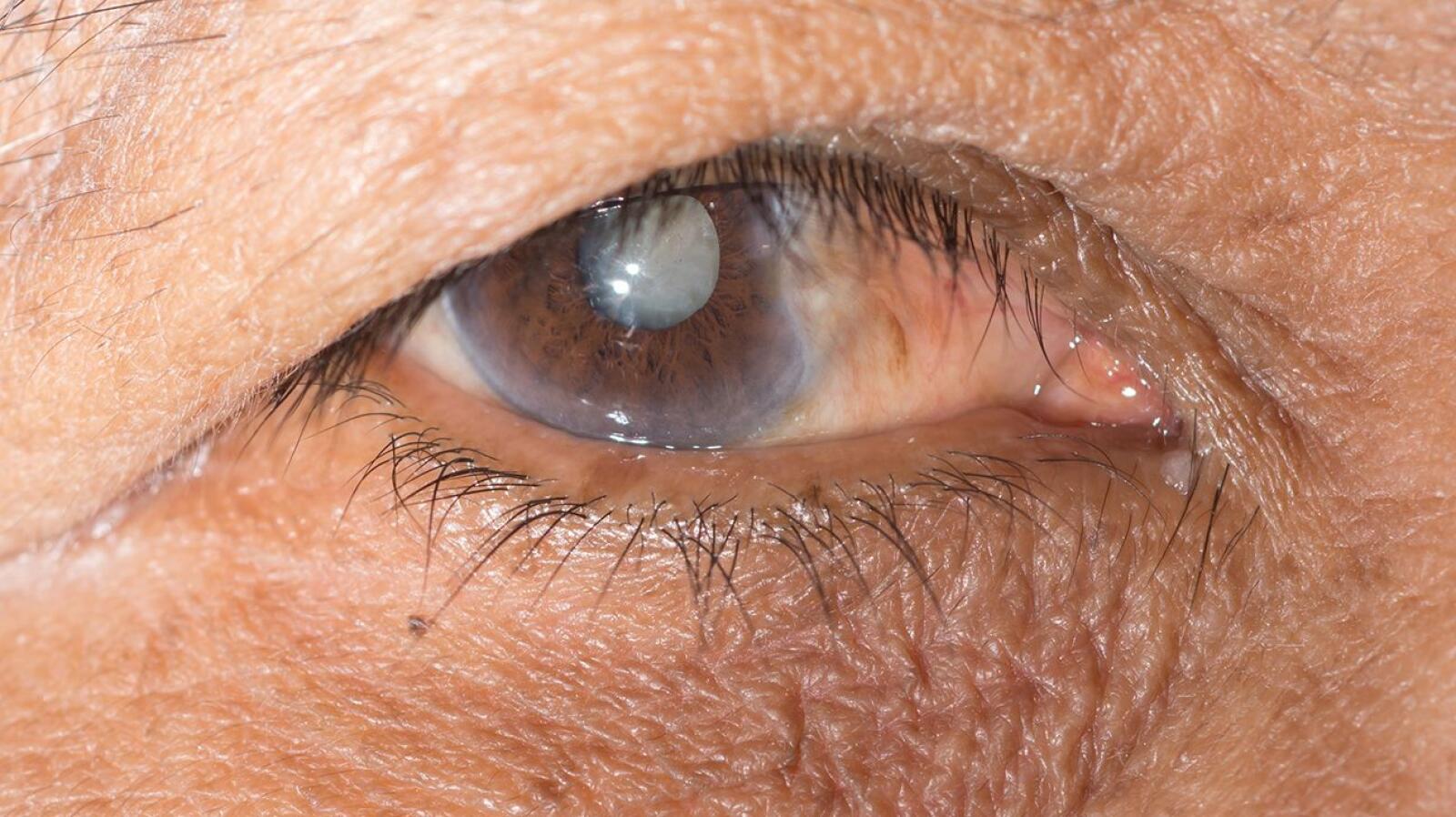 What Is a Nuclear Cataract? Symptoms, Causes, and Treatment