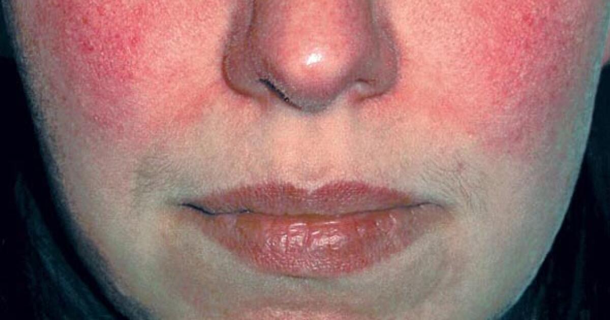 The Stages of Rosacea