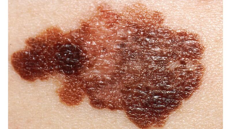 What Does Skin Cancer Look Like? Signs, Pictures, and More