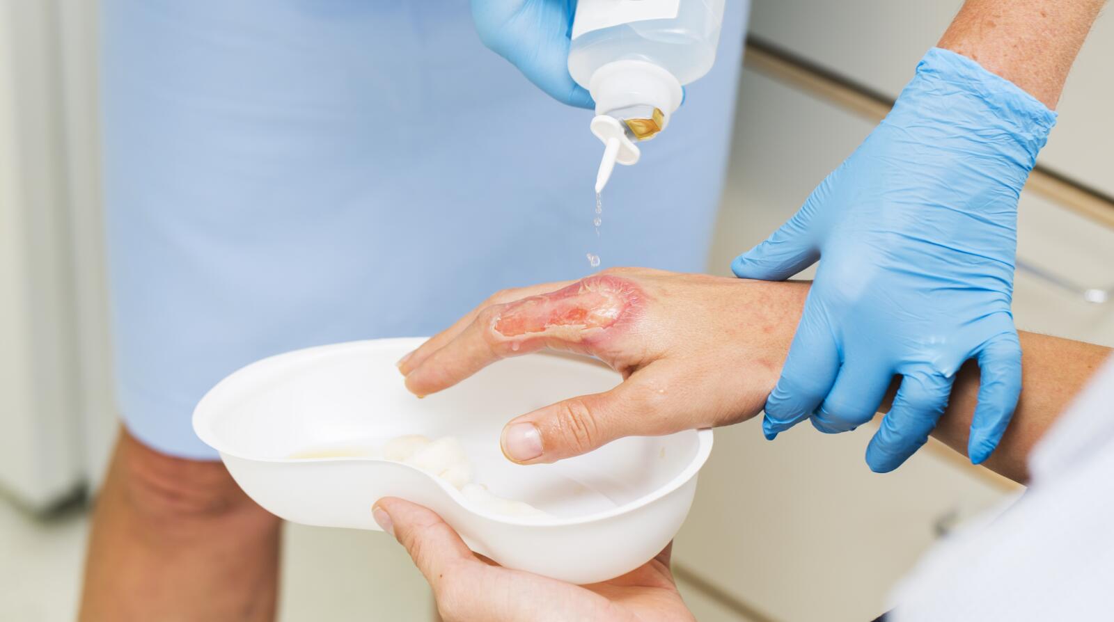 10 Things to Know About Burns | How to Treat 2nd and 3rd Degree Burns