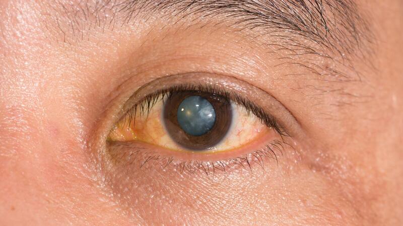 cortical cataract causes