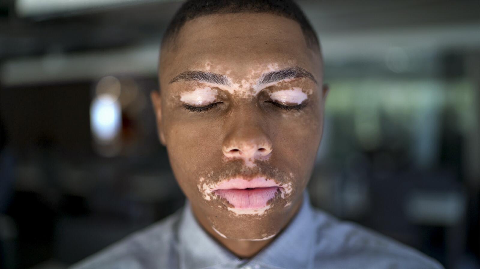 Treating Hypopigmentation: Causes, Remedies, and More