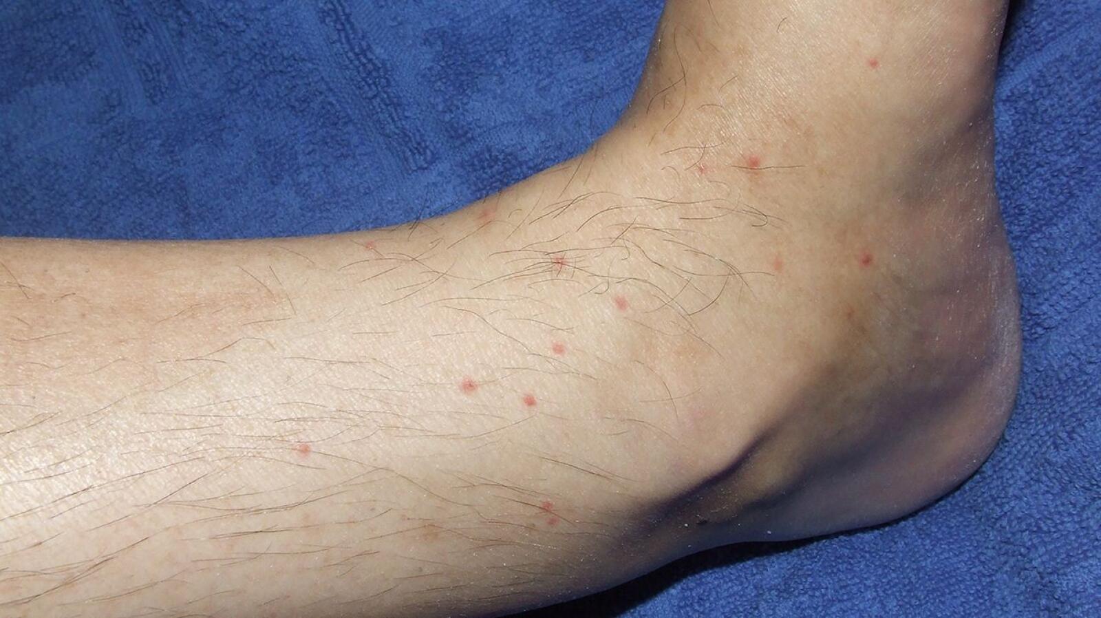 Bug Bites in a Line: Identification, Treatments, and More