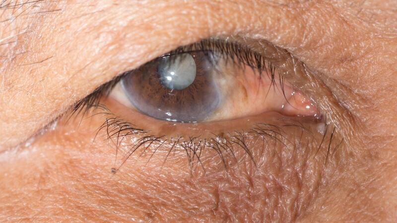 What Is a Nuclear Cataract? Symptoms, Causes, and Treatment