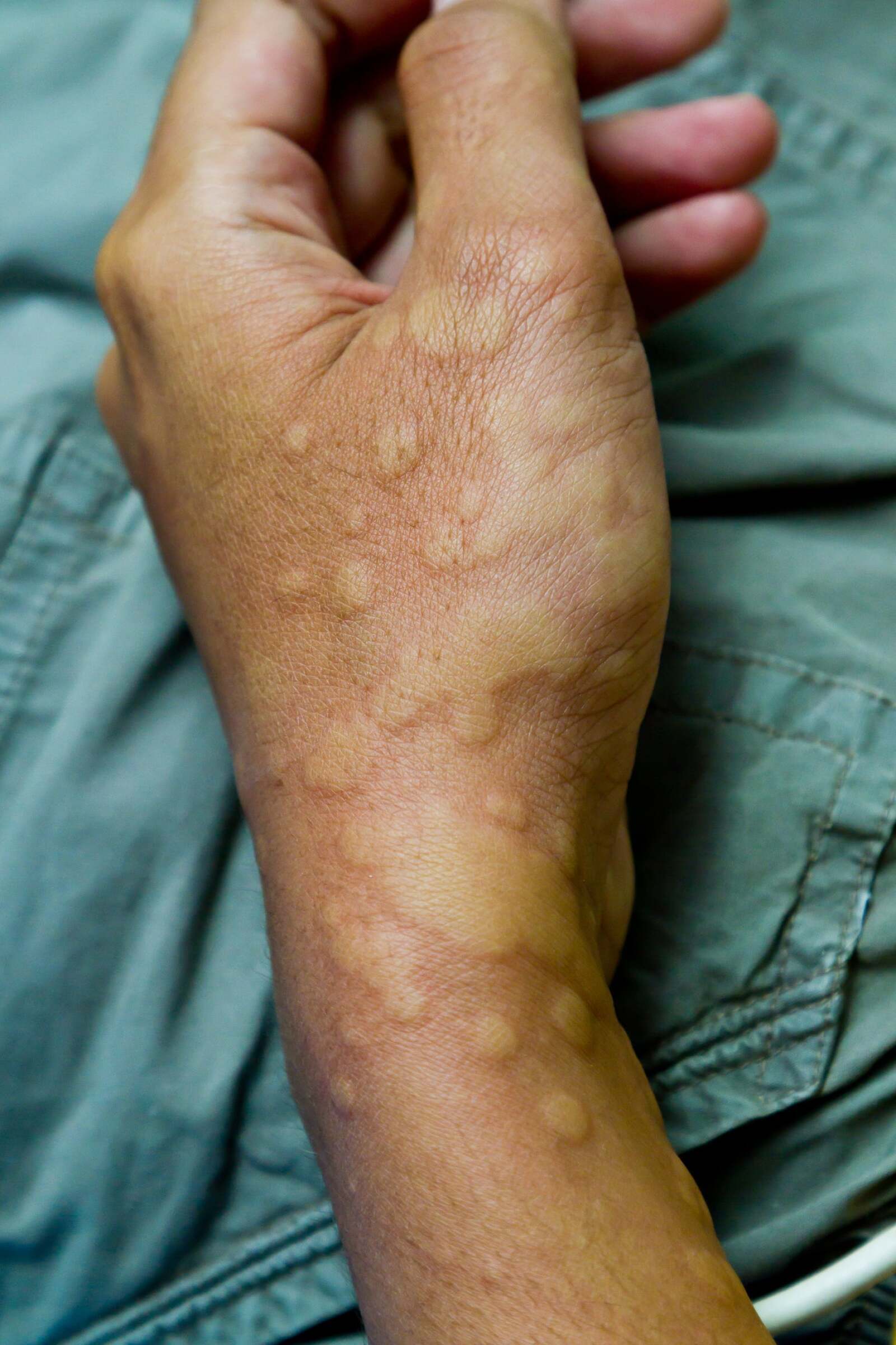 Cold Urticaria: Symptoms, Causes, and Treatment