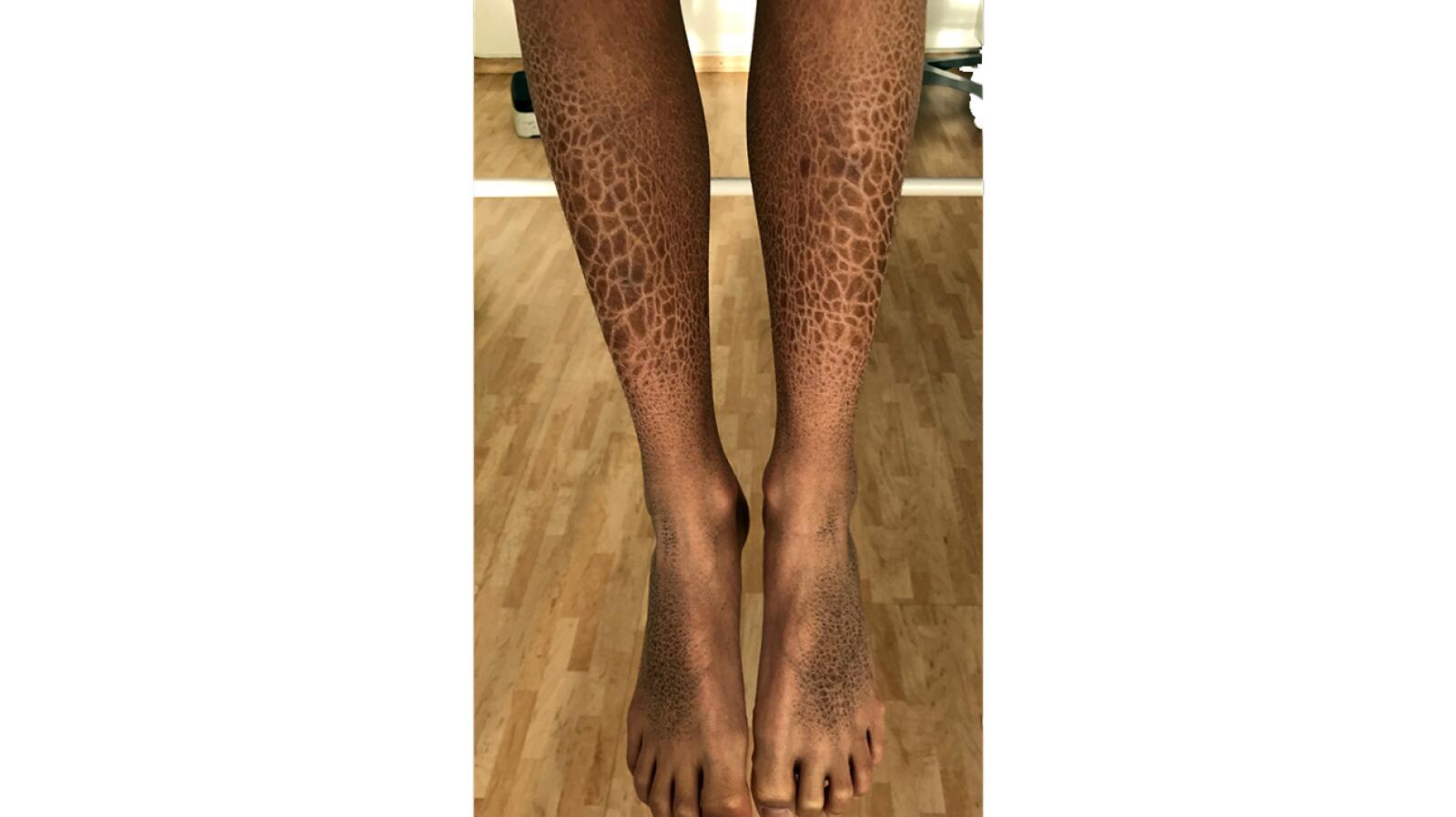 Ichthyosis Types Symptoms Causes And More