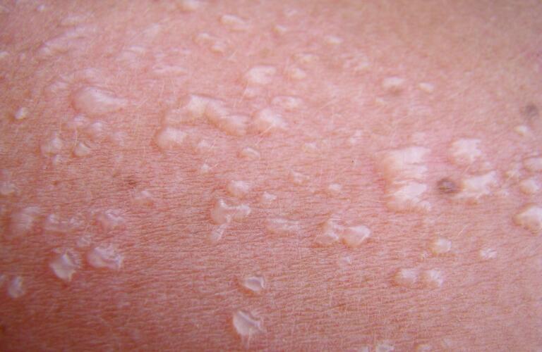 Blisters Symptoms Causes Treatments Blisters Symptoms Causes Treatments