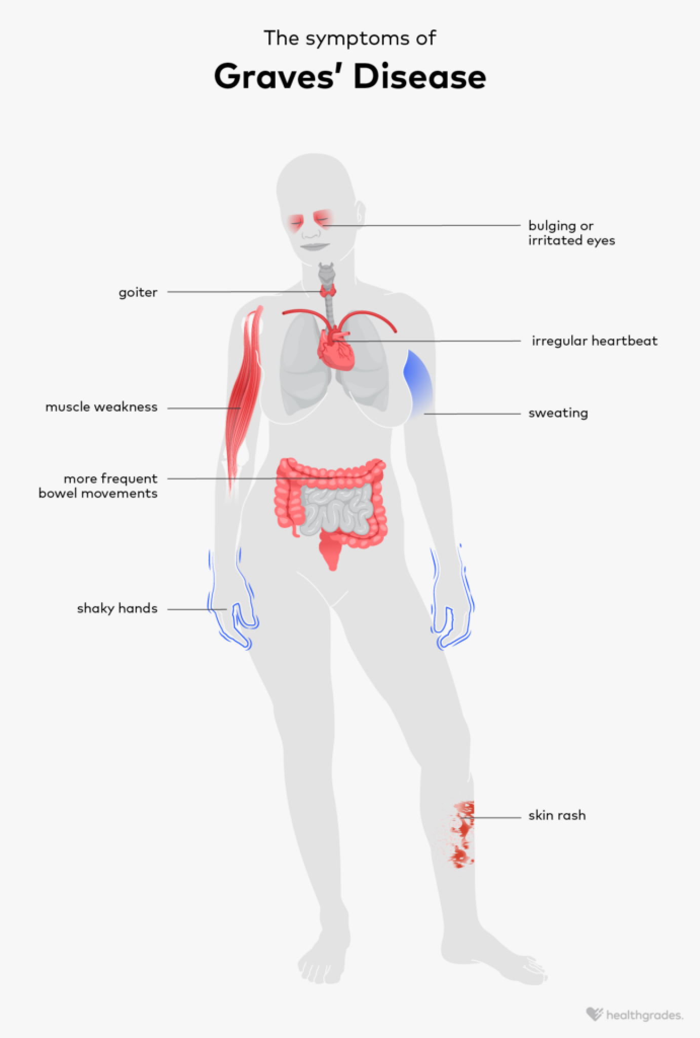Graves Disease Symptoms Causes And Treatment Graves Disease Symptoms Causes And Treatment