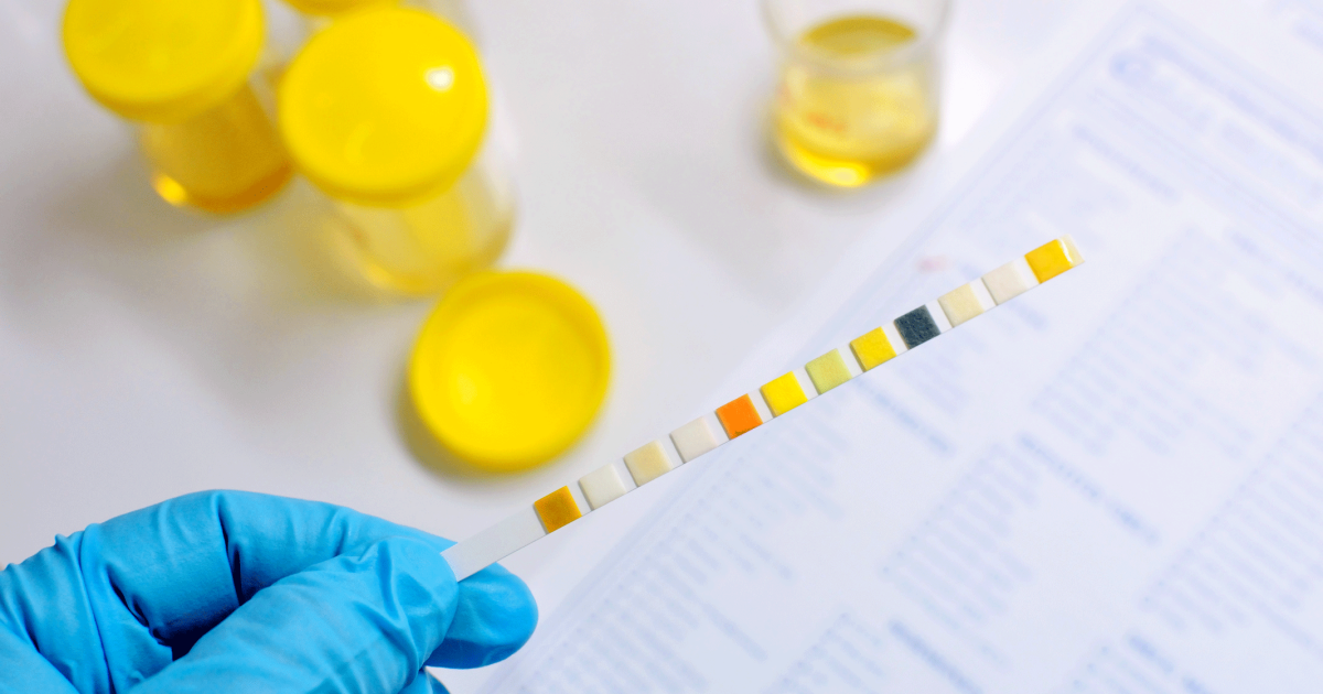 Darkened Urine - Symptoms, Causes, Treatments