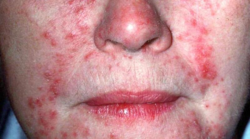 rosacea cheeks mild