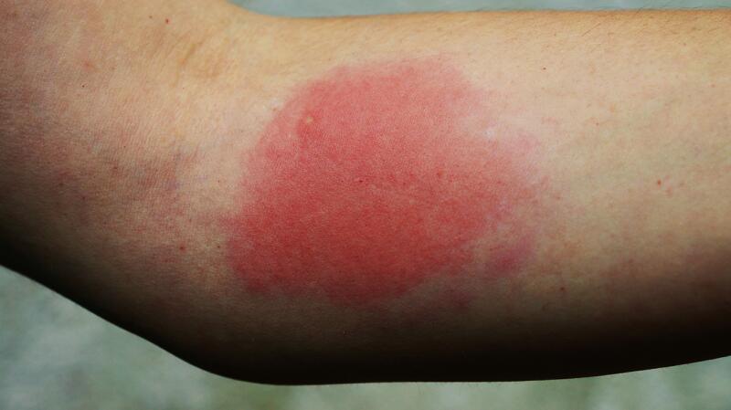 Bug Bite Pictures: Symptoms, Identification, Treatment, and More