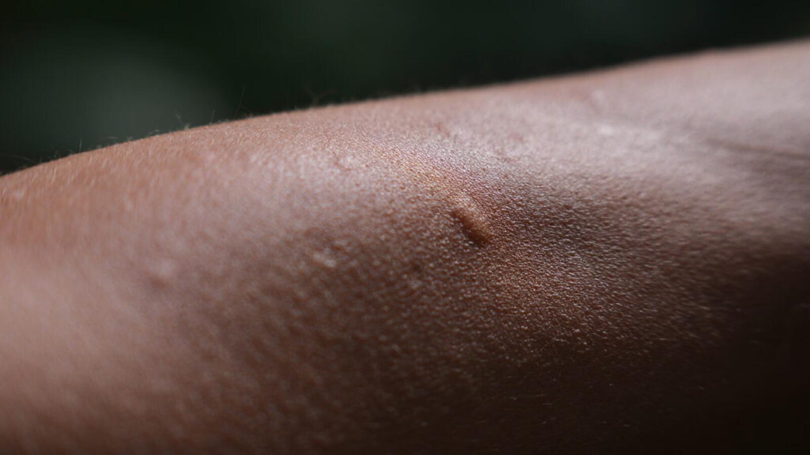 Bug Bite Pictures: Symptoms, Identification, Treatment, and More