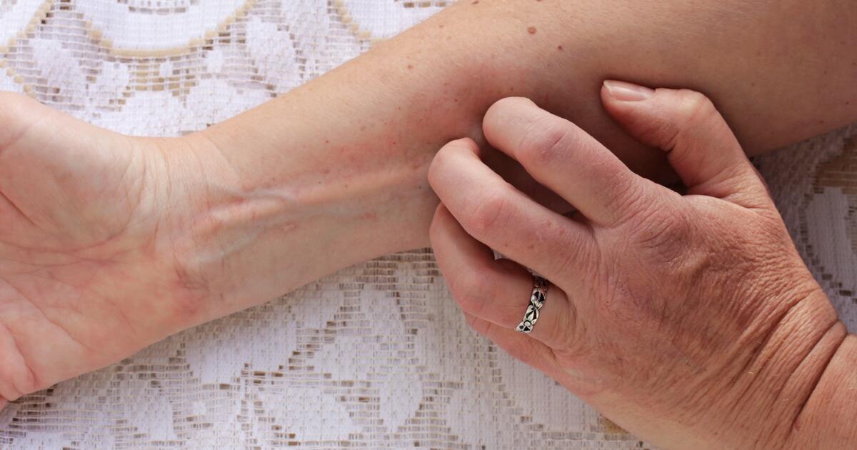 Hep C Symptoms Skin | Hep C Rash