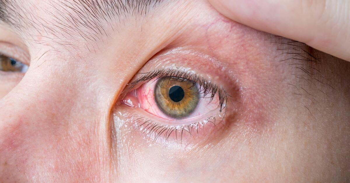Red Eyes: Causes, Treatments & When to See a Doctor | Bloodshot Eyes