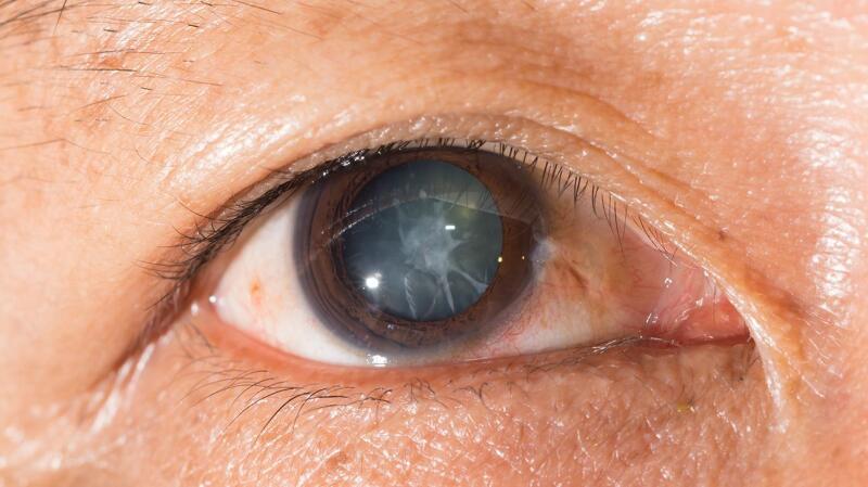 What Is a Cortical Cataract? Symptoms, Causes, and Treatment
