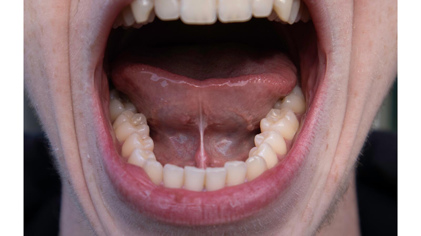 Tongue-Tie (Ankyloglossia): Pictures, Treatments, and More