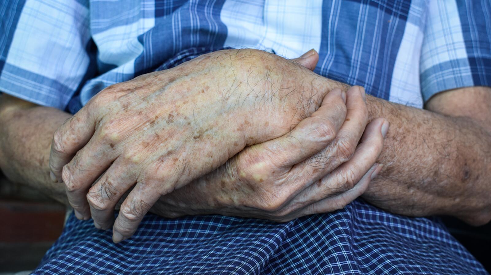 Sun Damaged Skin: Appearance, Causes, Treatments, and More