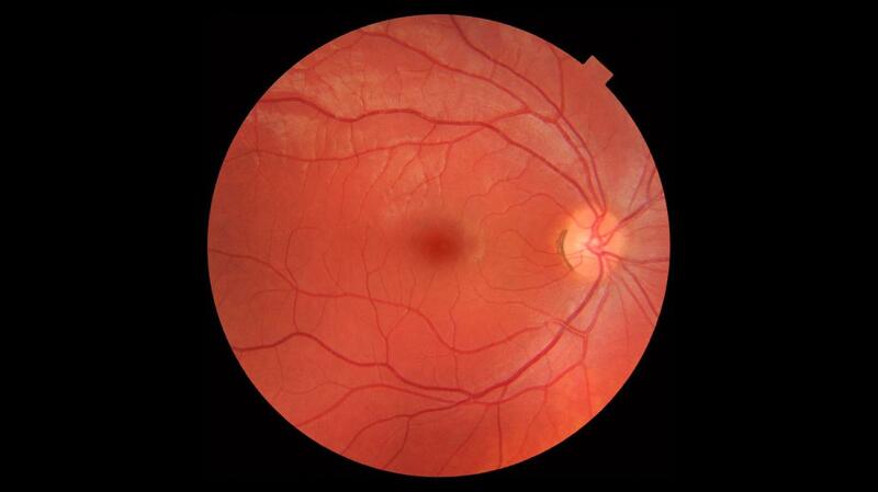 Stages of Macular Degeneration: Symptoms, Treatment, Outlook