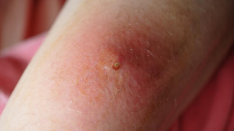 Boils Skin Information | 8 Things to Know About Boils