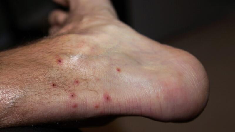Bug Bite Pictures: Symptoms, Identification, Treatment, and More