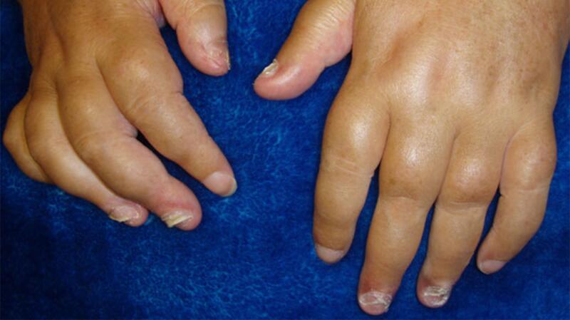 Dactylitis (Sausage Fingers): Causes and Treatments