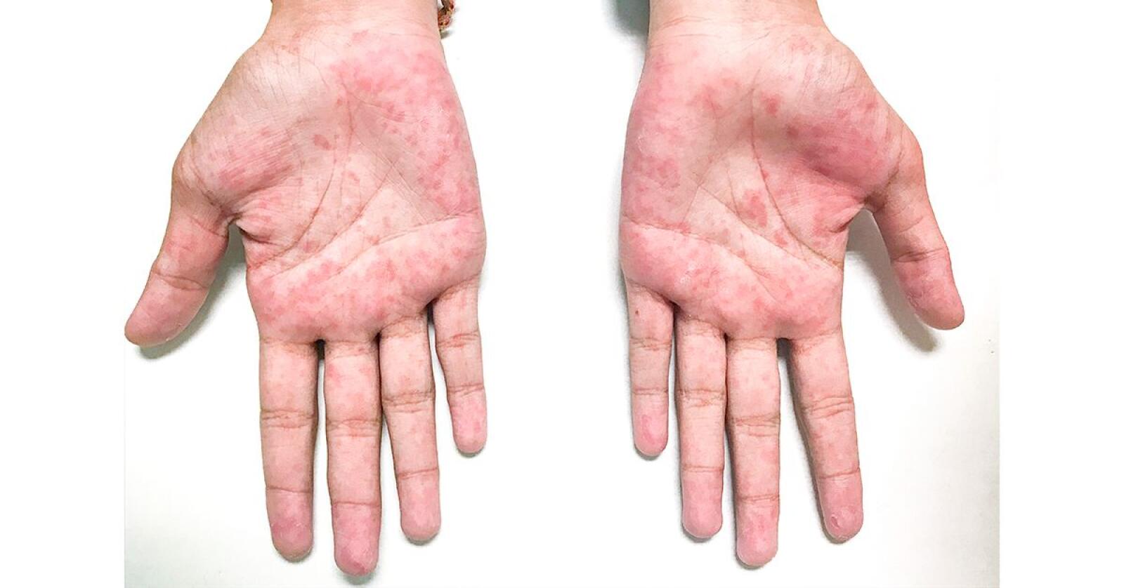 Rash On Palms: Causes, Treatments, and More