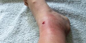 7 Types of Foot Rashes & How to Treat Them | Causes of Foot Rash