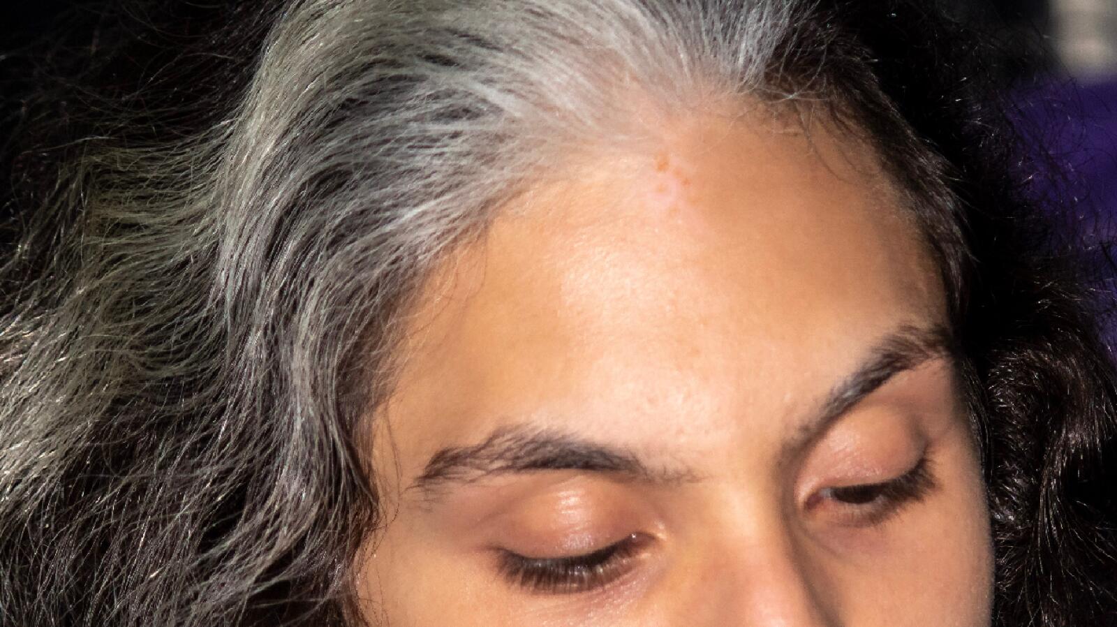 Poliosis: Appearance, Causes, Treatments, and More