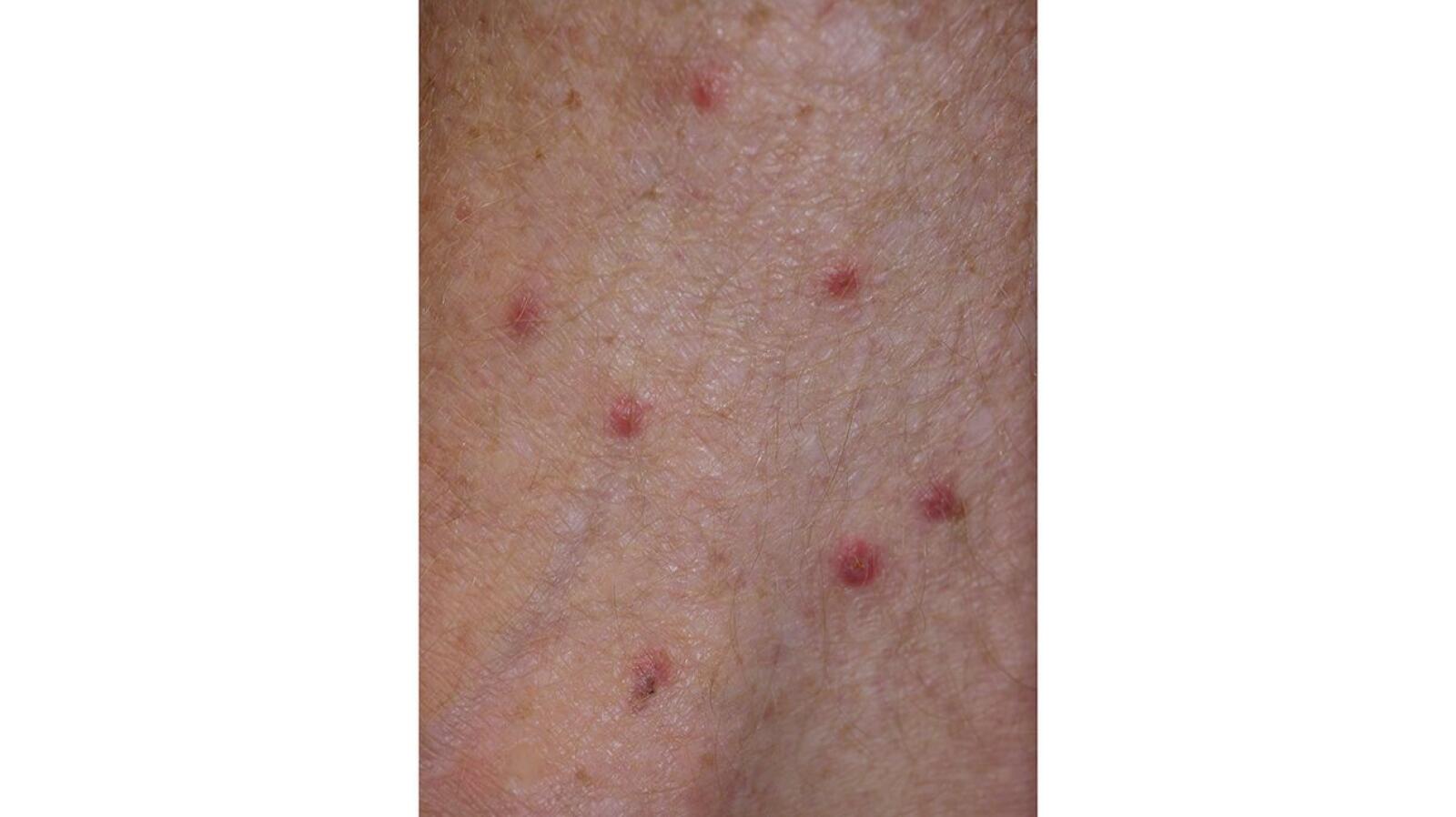 Bug Bites in a Line: Identification, Treatments, and More