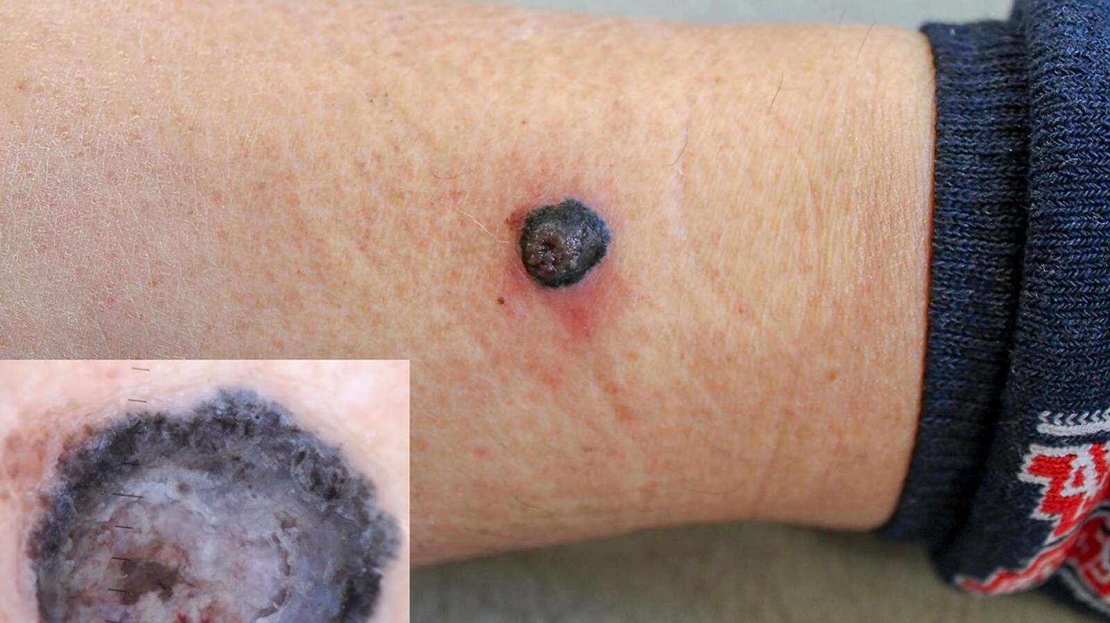 Nodular Melanoma Pictures: Symptoms, Treatment, and More Nodular Melanoma Pictures: Symptoms, Treatment, and More